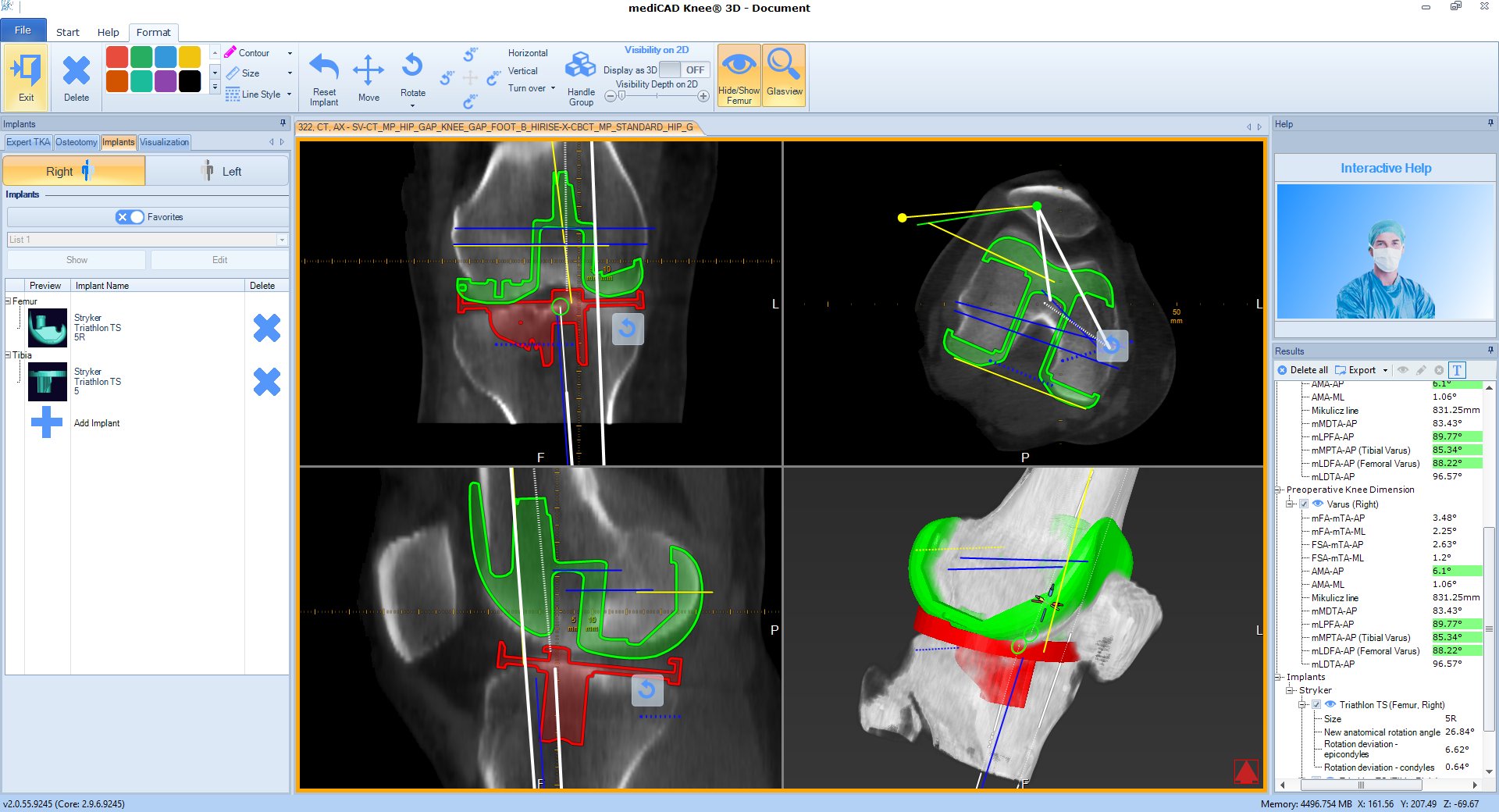 Improve TKA & Osteotomy Planning w/ Full Leg WBCT - CurveBeam AI