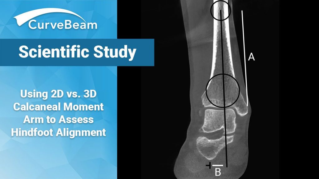 Assessment of Hindfoot Alignment Comparing WB X-Ray to WBCT - CurveBeam AI