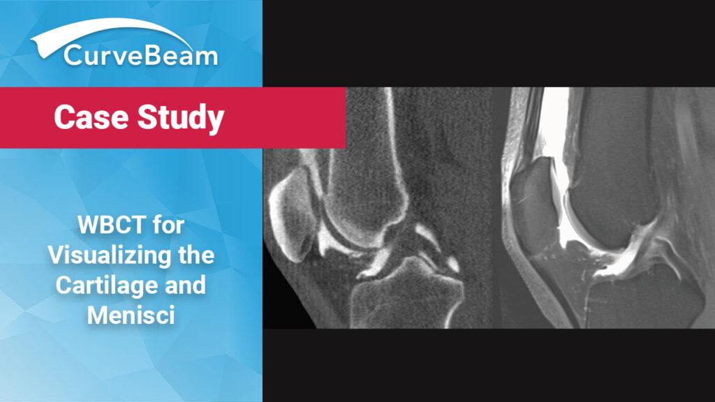 Case Study: WBCT for Visualizing the Cartilage and Menisci - CurveBeam AI