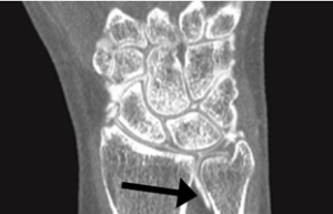 Visualizing TFCC Tears at the Point-of-Care - CurveBeam AI