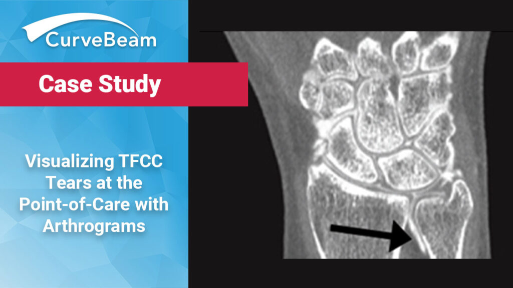 Visualizing TFCC Tears at the Point-of-Care - CurveBeam AI