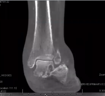 WBCT Indication Series: Charcot Arthropathy - CurveBeam AI