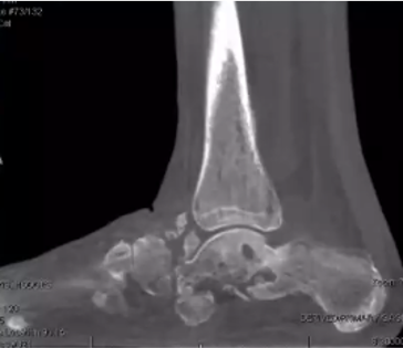 WBCT Indication Series: Charcot Arthropathy - CurveBeam AI