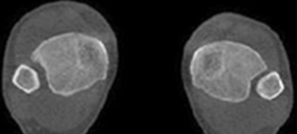 WBCT Indications Series: Syndesmosis - CurveBeam AI