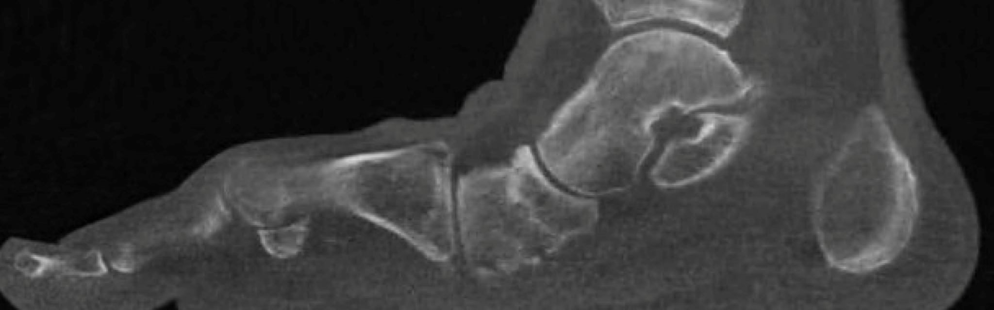 WBCT Indications Series: Midfoot Arthritis - CurveBeam AI