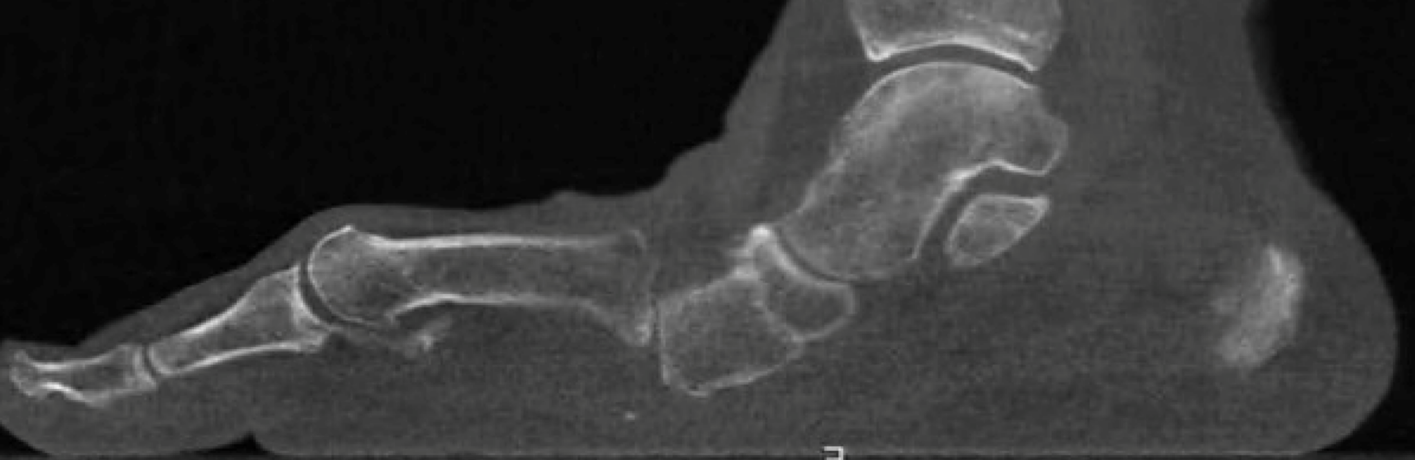 WBCT Indications Series: Midfoot Arthritis - CurveBeam AI