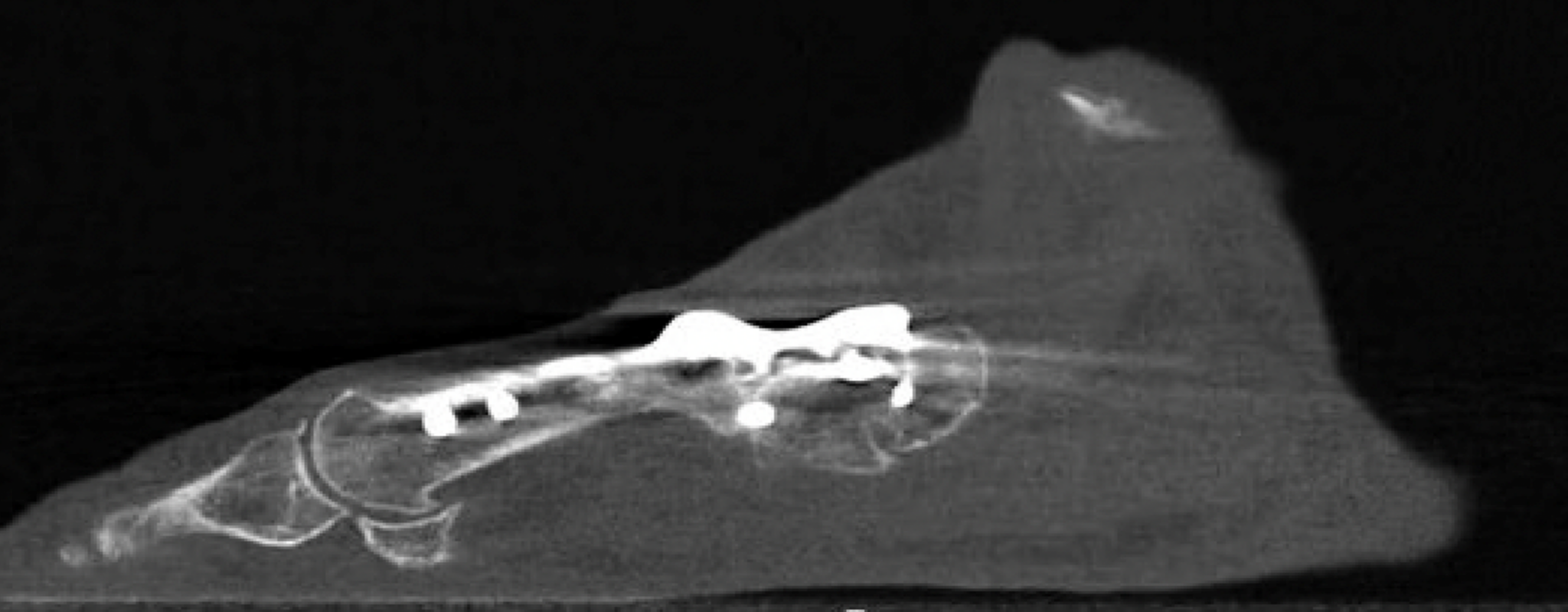 WBCT Indications Series: Midfoot Arthritis - CurveBeam AI
