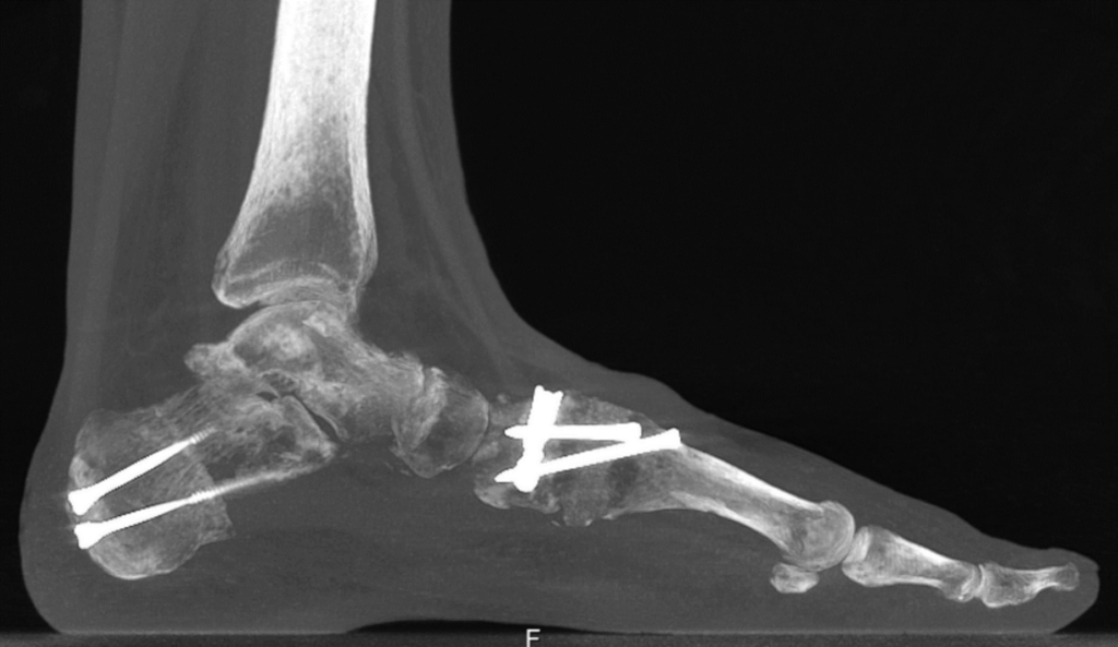 WBCT Indications Series: PCFD - CurveBeam AI